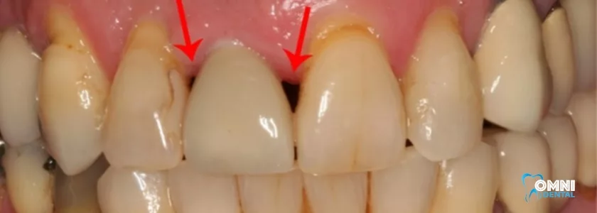 Early Periodontal Disease- Arlington Heights IL - Omni Dental Of ...